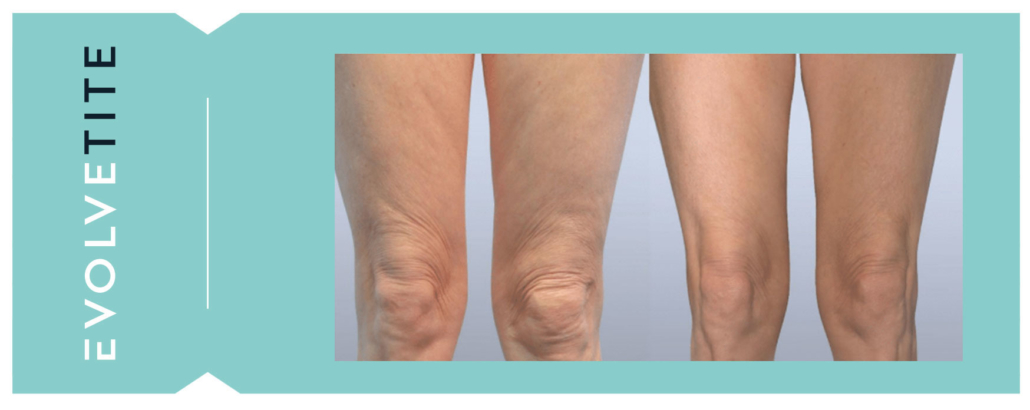 Evolve Tite Non-Invasive Thermal Skin Tightening & Cellulite Treatment Evolve Tite Non-Invasive Thermal Skin Tightening & Cellulite Treatment
