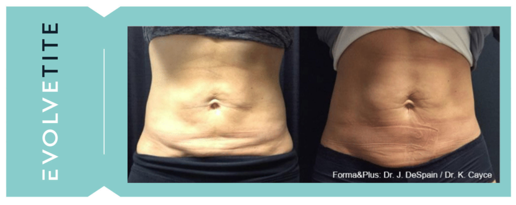 Evolve Tite Non-Invasive Thermal Skin Tightening & Cellulite Treatment